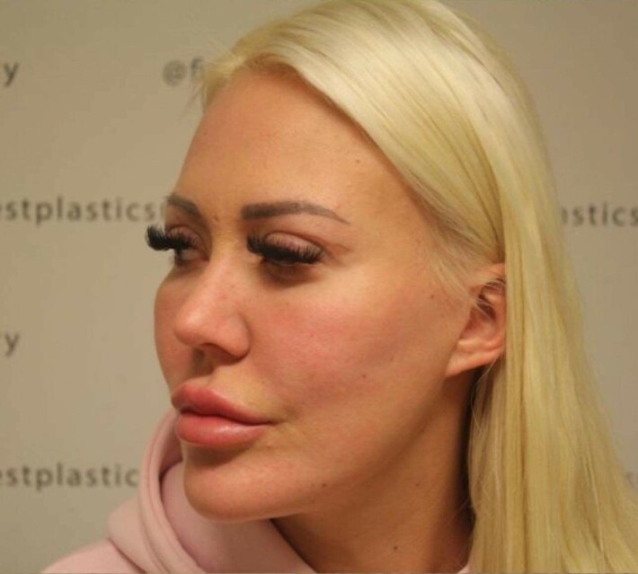 Sandra Bay kävi radikaalissa kasvoleikkauksessa – tältä hän näyttää nyt!