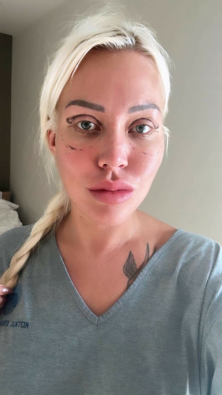 Sandra Bay kävi radikaalissa kasvoleikkauksessa – tältä hän näyttää nyt!