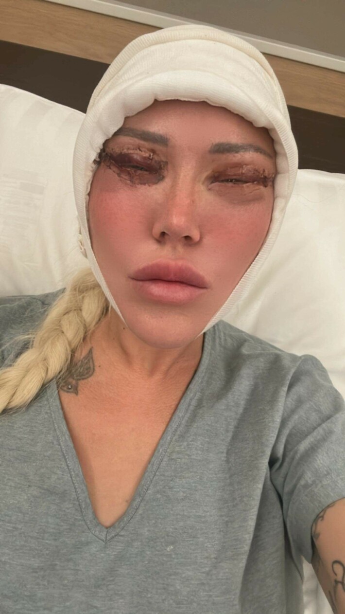 Sandra Bay kävi radikaalissa kasvoleikkauksessa – tältä hän näyttää nyt!