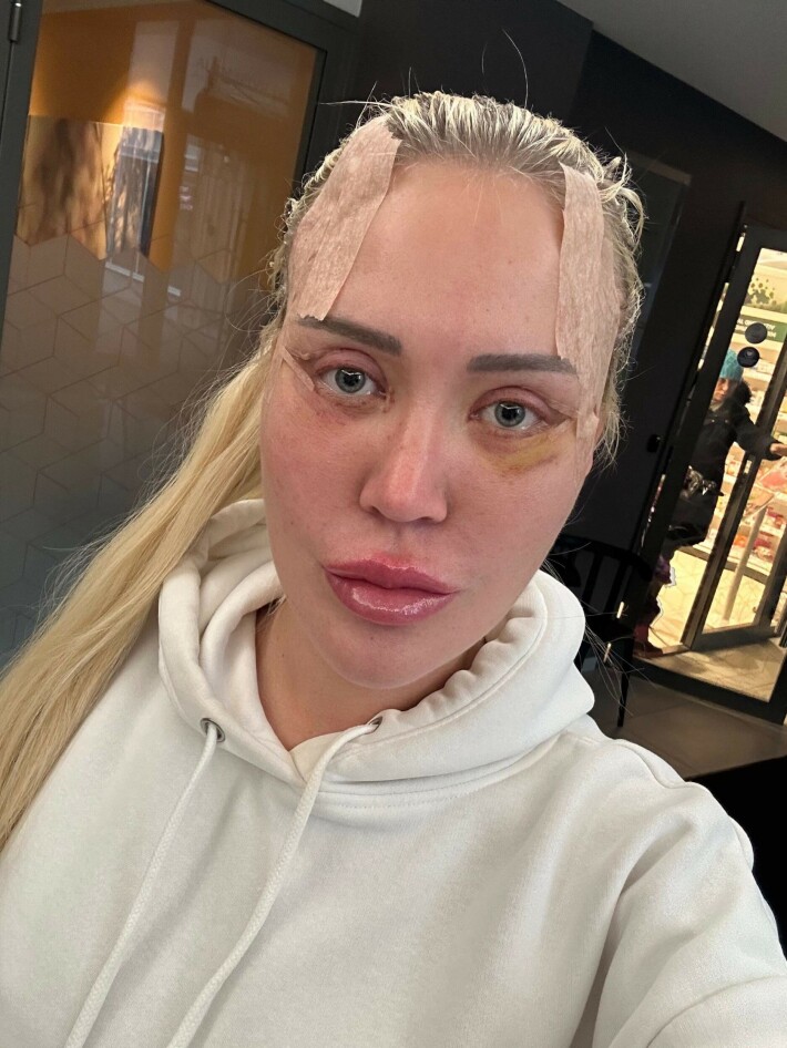 Kasvoleikkauksessa olleelta Sandra Baylta poistettiin tikit: "Sain ne ...